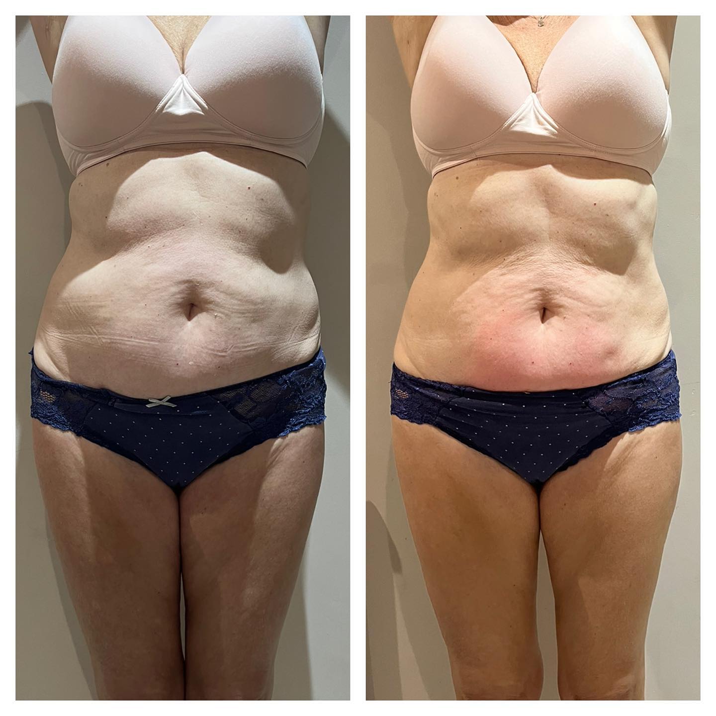 The One Lounge | One Lounge News | 3D Lipo Body Contouring