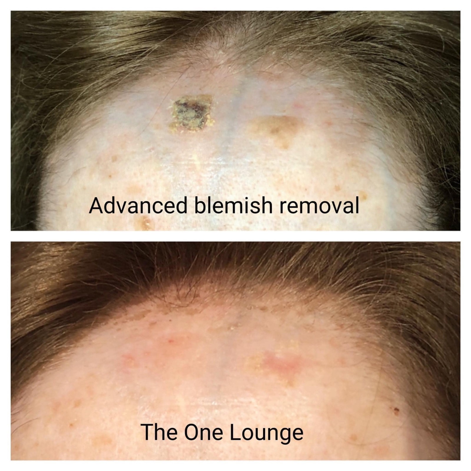 The One Lounge | One Lounge News | Are you bothered by unwanted marks ...